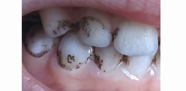 Discoloration of childrens teeth - Bloorkids Dental