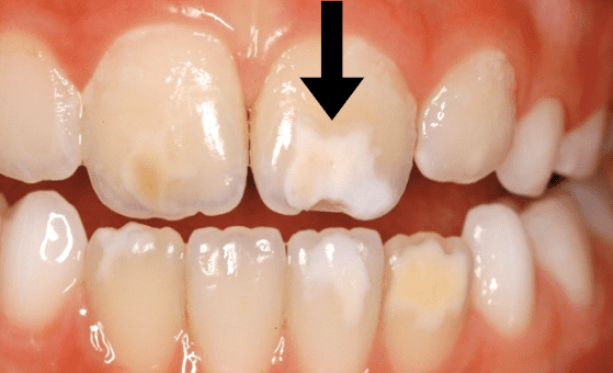 Discoloration of childrens teeth - Bloorkids Dental