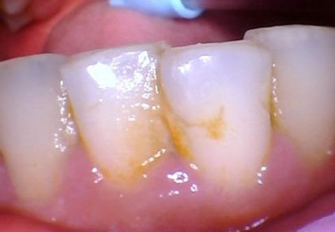 Discoloration of childrens teeth - Bloorkids Dental